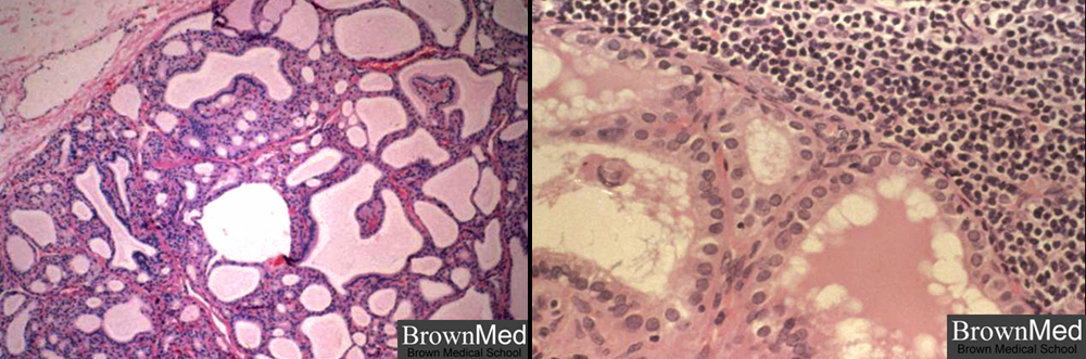 Graves Disease